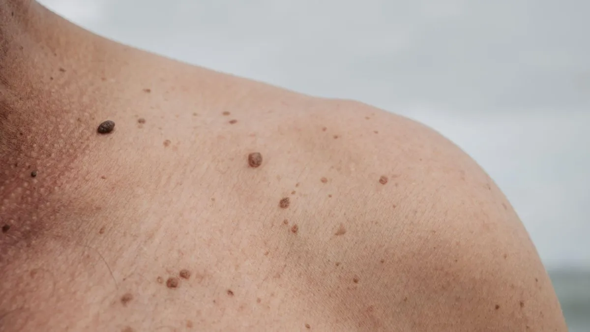 Alberto Conde, dermatologue, sur le mélanome : les coups de soleil ...